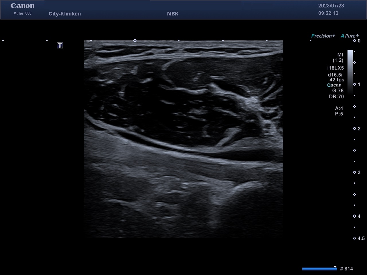 Ultraljud armbåge - Naprapat i Göteborg – City-kliniken
